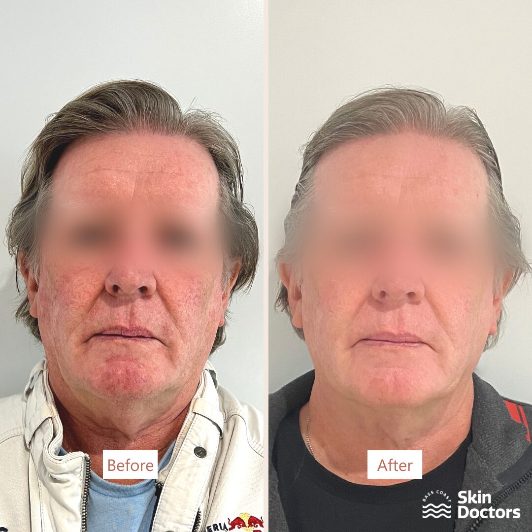 Intense pulsed light (IPL) - Bass Coast Skin Doctors