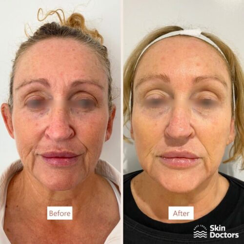 Tixel skin rejuvenation - Bass Coast Skin Doctors