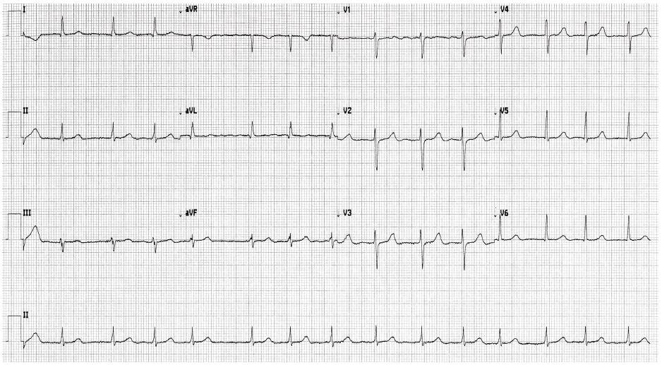 mechanical mitral valve