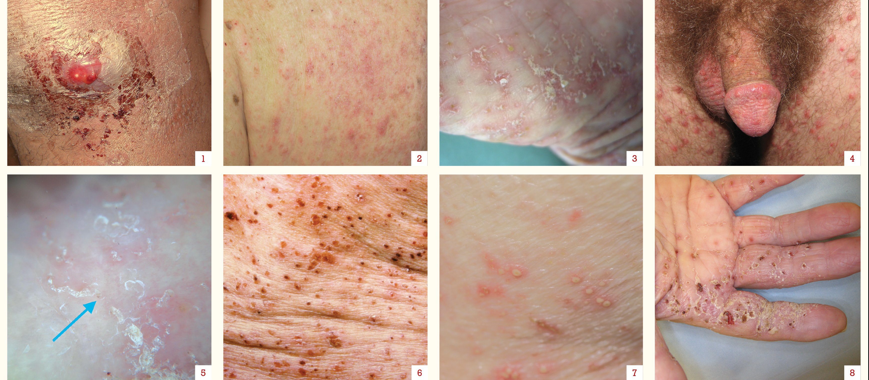scabies std rash