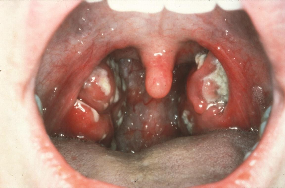 tonsillar hypertrophy grading
