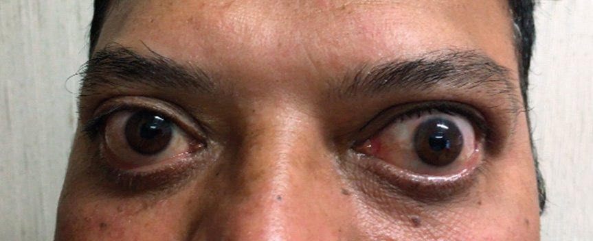 outer eyebrows hypothyroidism