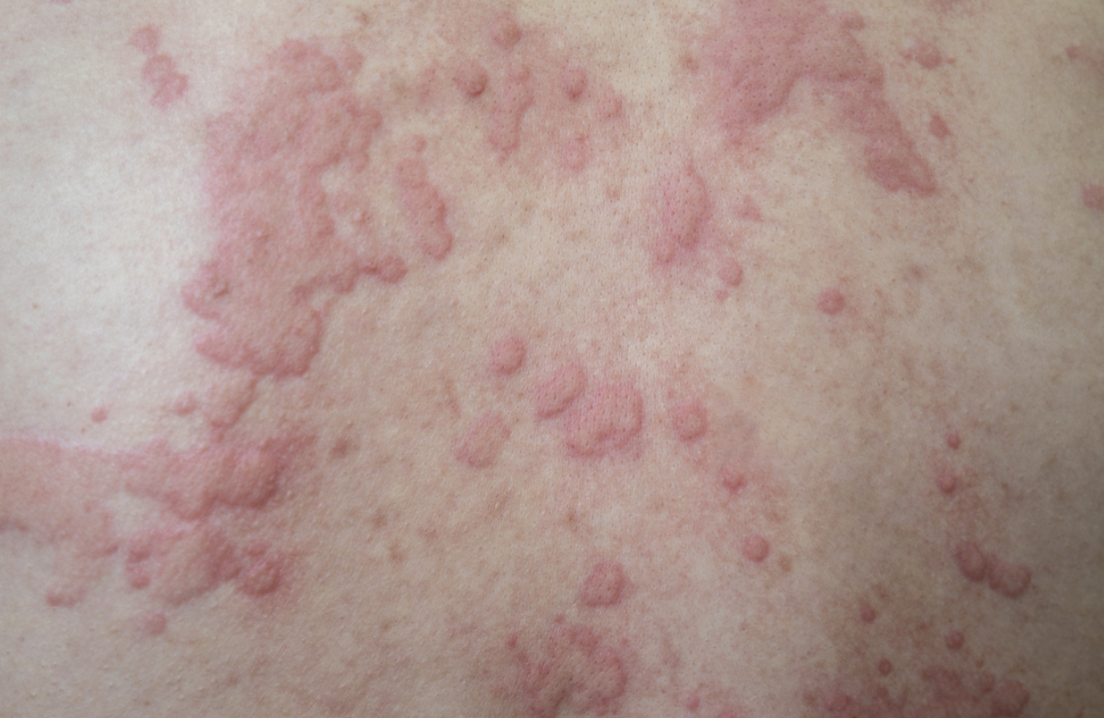 Urticaria: Itching to get relief from raised bumps and rash | Pharmacy ...