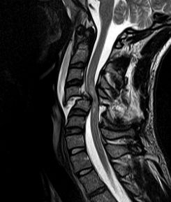 Spinal cord injury - WikEM