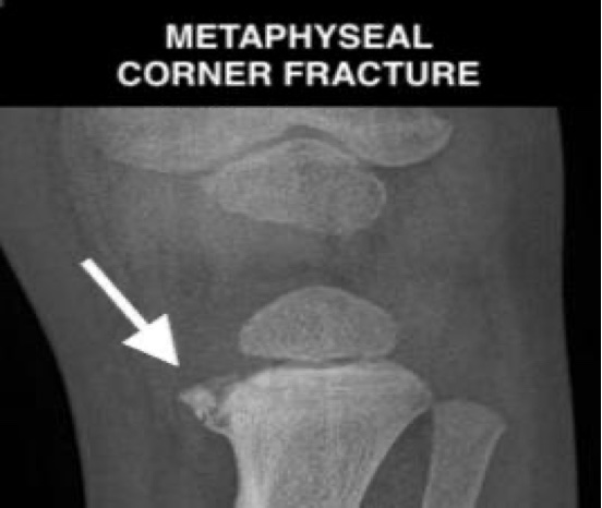 File:Child Protection - Child Abuse and Neglect - Metaphyseal Chip ...