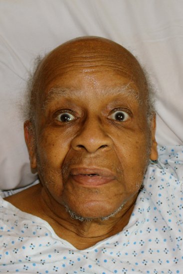 Facial paralysis - WikEM