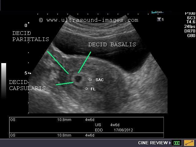 File:Double decidual sac sign.jpg - WikEM