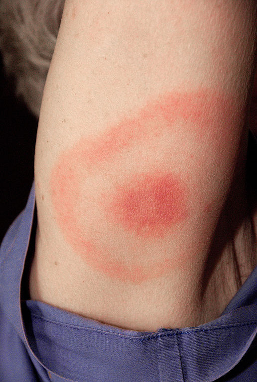 Lyme disease - WikEM