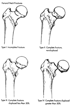 Intertrochanteric Fractures Classifications Classification Evans 1949 ...