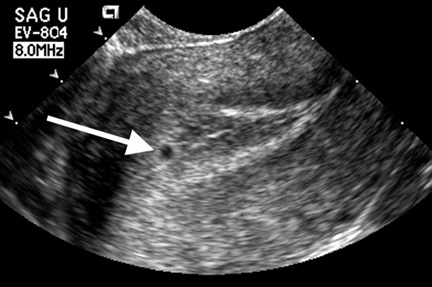 Ultrasound: Pelvic - WikEM