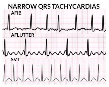 ACLS: Tachycardia - WikEM