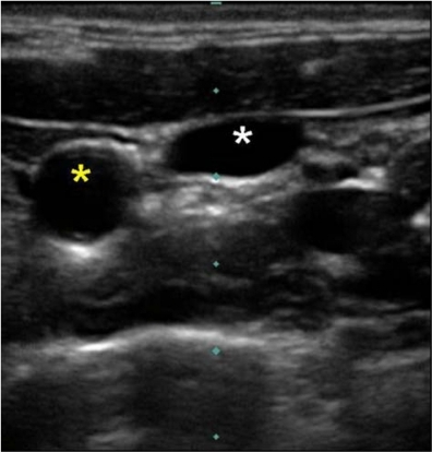 Central line: internal jugular - WikEM