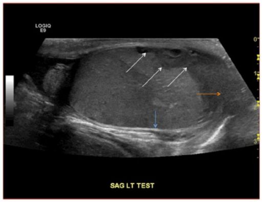 Testicular trauma - WikEM