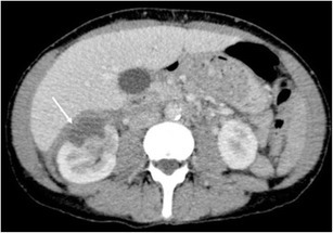 Renal abscess - WikEM