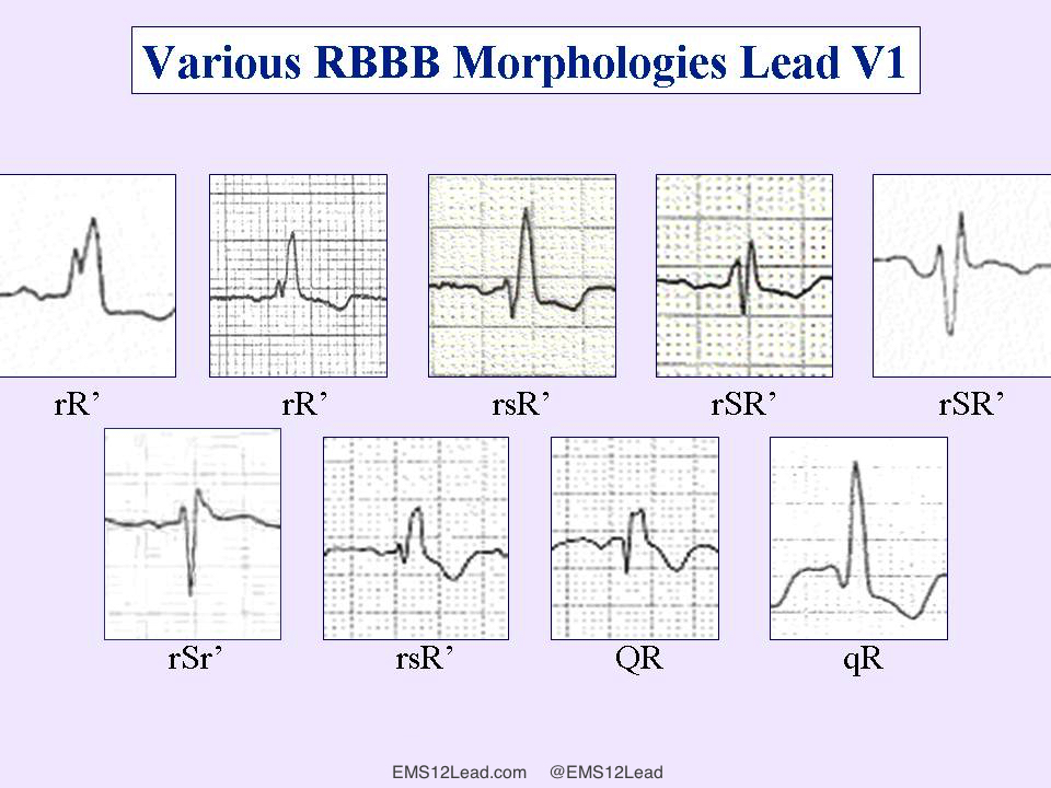 File Rbbb Morphology Lead Vi Wm jpg WikEM