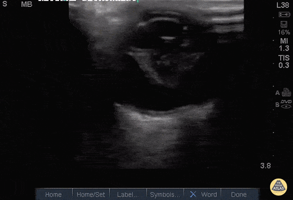 File:Segarra retinal detachment.gif - WikEM