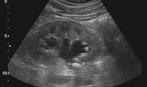 Urolithiasis - WikEM