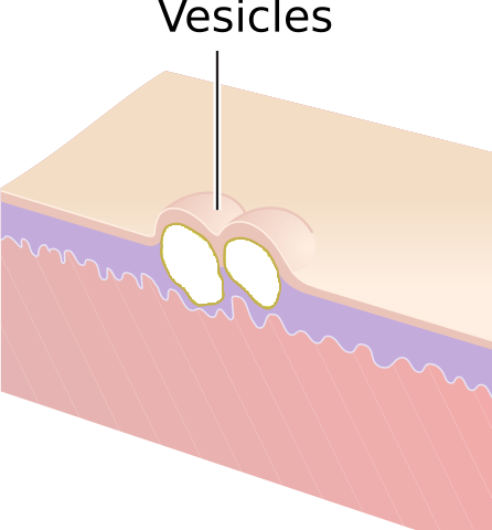 File:Vesicles (2).png - WikEM