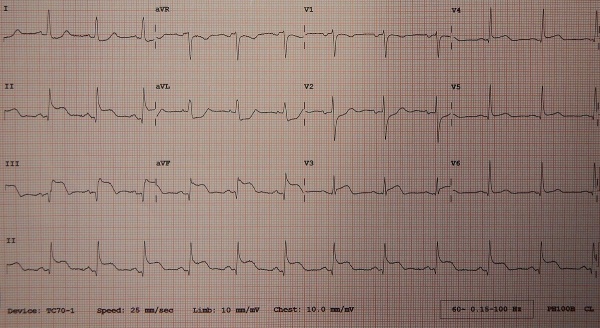ST-segment elevation myocardial infarction - WikEM