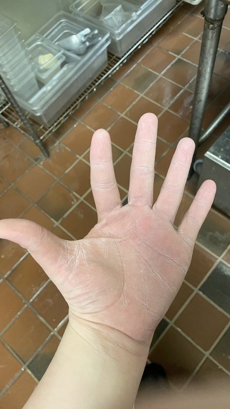 Caustic burn - WikEM