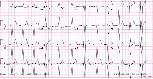 Pacemaker complication - WikEM