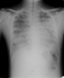 Chest x-ray interpretation - WikEM