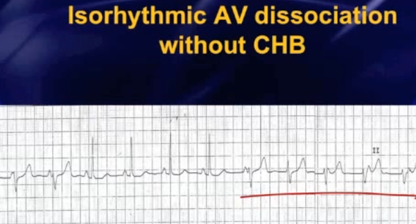 Third degree AV block - WikEM