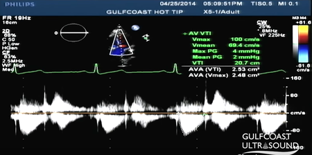 Aortic stenosis - WikEM