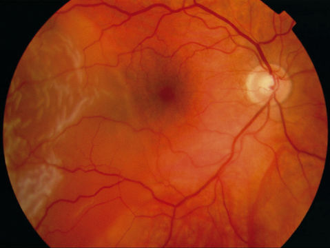 Acute vision loss (noninflamed) - WikEM