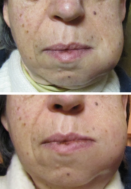 Dental abscess - WikEM