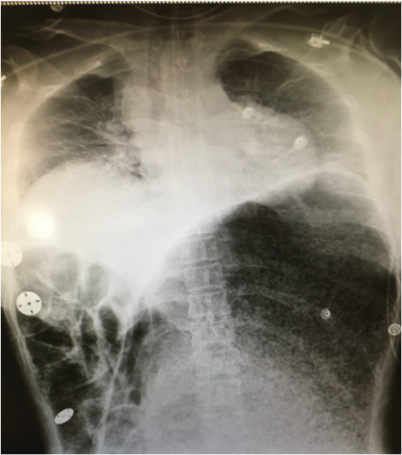 Acute gastric dilatation - WikEM