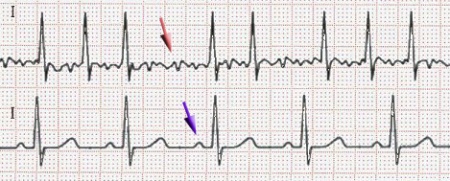 Atrial fibrillation with RVR - WikEM