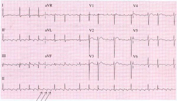 Atrial flutter - WikEM