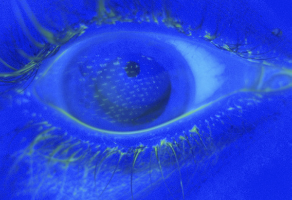 Airbag injuries - WikEM