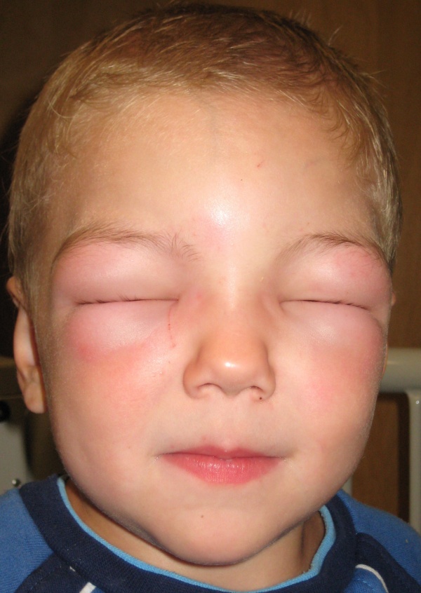 Angioedema - WikEM