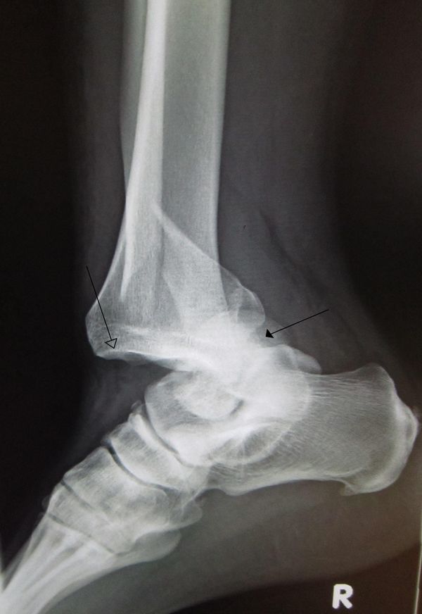 Ankle dislocation - WikEM