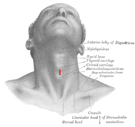 Surgical cricothyrotomy - WikEM
