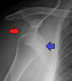 Shoulder dislocation - WikEM