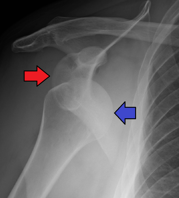 Anterior shoulder dislocation - WikEM
