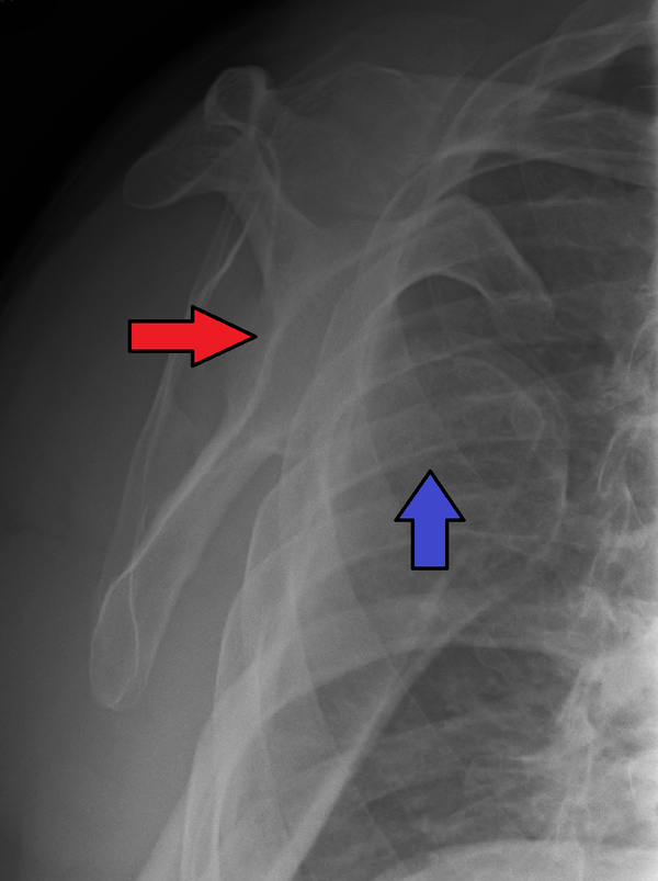 Anterior shoulder dislocation - WikEM