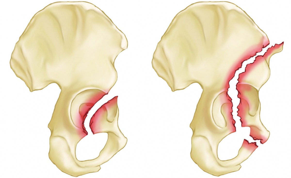 File:Anterior fractures.jpg - WikEM