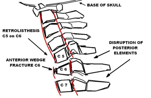 Anterior cervical wedge fracture - WikEM