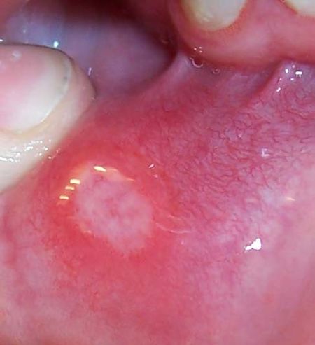 Aphthous stomatitis - WikEM
