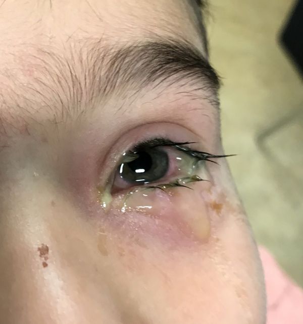 Bacterial conjunctivitis - WikEM