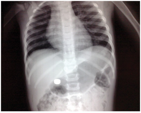 Ingested foreign body - WikEM