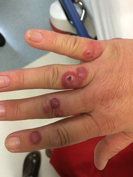 Hand and finger infections - WikEM