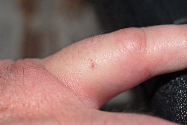 Hymenoptera stings - WikEM