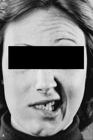 Bell's palsy - WikEM