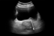 Bladder ultrasound - WikEM