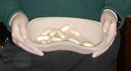 Body packing - WikEM